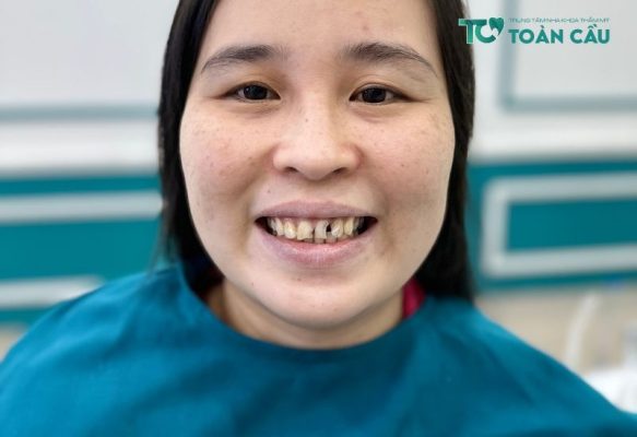Nha khoa trám răng Gò Vấp giá rẻ, giữ được lâu
