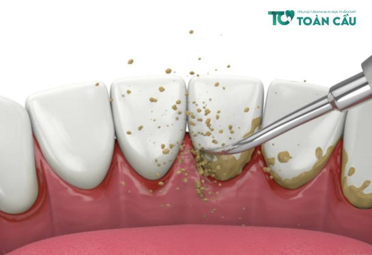 Có nên lấy cao răng thường xuyên không? Bao lâu lấy 1 lần?