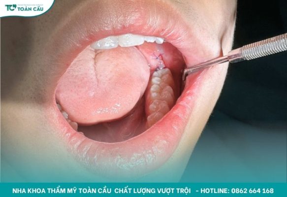 Địa chỉ nhổ răng Gò Vấp giá rẻ tại Nha Khoa Thẩm Mỹ Toàn Cầu